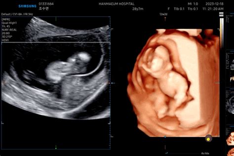 임신 12~13주차 창원 한마음병원 산부인과에서 입체 정밀 초음파 검사 1차 기형아검사비용 종류 다운증후군 선별검사 네이버 블로그