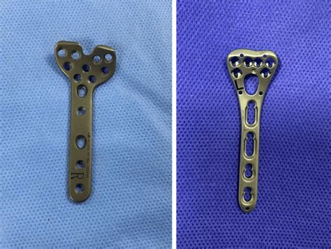 Fixed Angle And Variableangle Locking Plates Used In The Included Cases