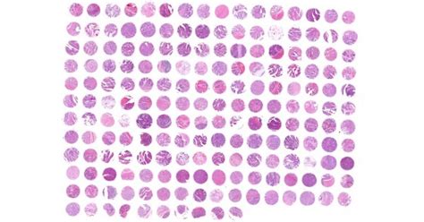 Co1861 Colon Cancer With Colon Tisue Array Including Pathology Grade