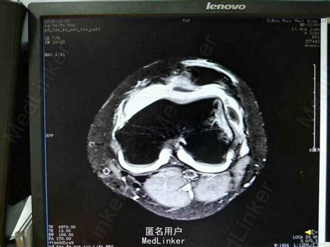 髌骨内关节面骨软骨骨折关节镜辅助下复位内固定手术 医联