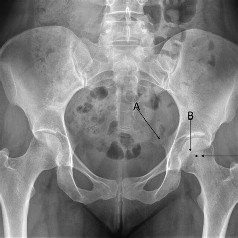 The Radiographic Findings Of Acetabular Retroversion Consist Of A Download Scientific Diagram
