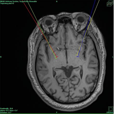 Target Set For Gpi Pallidotomy In Ips Software Axial Mri Image