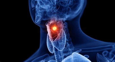 Doctors Warn Of Rise In Throat Cancer Cases Linked To Oral Sex Pulse