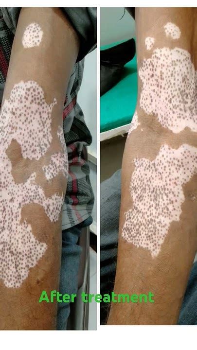 Result After Treatment Of Leucoderm Youtube