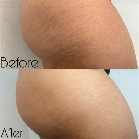 Body Scar Coverage Makeup