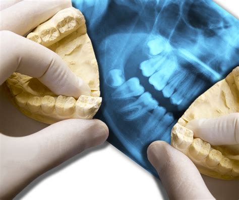 Overbite Vs Underbite My Line Aligner