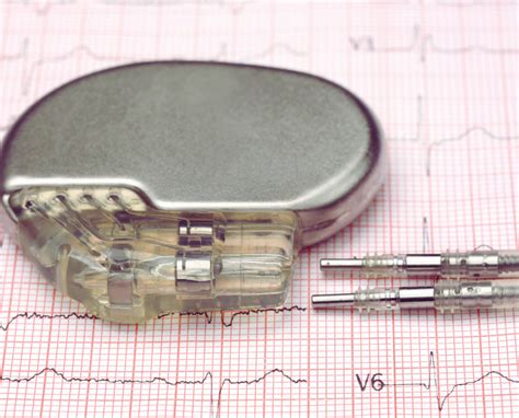 Pacemaker And Pacemaker Surgery A Complete Guide Docternist