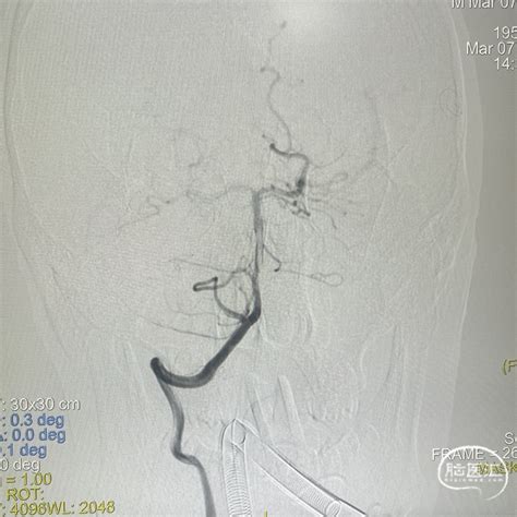 Time To Evolve 超越之旅 Surpass Evolve治疗外伤性假性动脉瘤一例及6个月随访 脑医汇