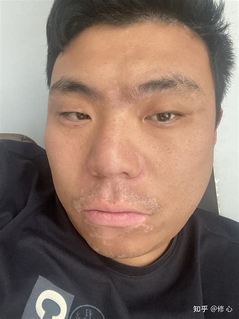 交流白癜风 知乎