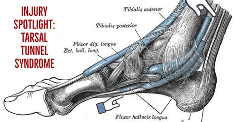 Exercises For Tarsal Tunnel Syndrome Tarsal Tunnel Sy