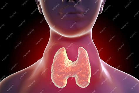Premium Photo Toxic Diffuse Goiter Flajanibasedowgraves Disease 3d Illustration Showing