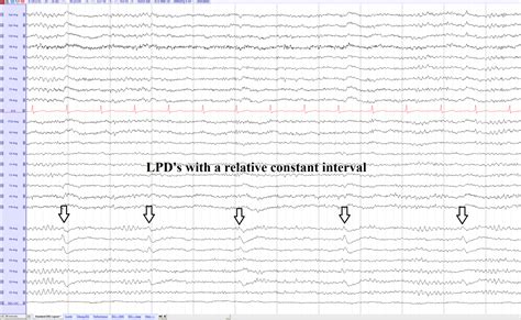 Lpd Lateralized Periodic Discharges Eegpedia