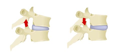 Facet Joint Syndrome Macomb Spine Care