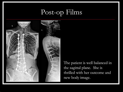 Case Review 42 39 Year Old Female With Adult Congenital Scoliosis Ppt