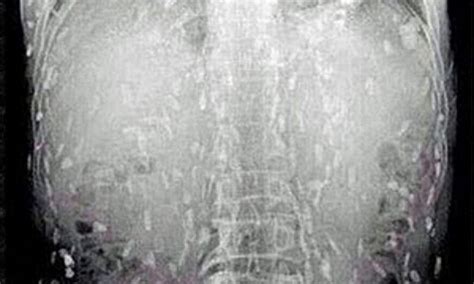 ΠΑΡΑΣΙΤΑ ΣΤΟ ΣΤΟΜΑΧΙ ΣΥΜΠΤΩΜΑΤΑ