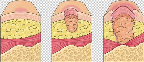 Ulcer Vector
