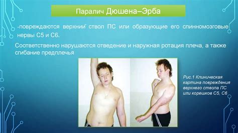 Поражения плечевого сплетения Варианты Дюшенна Эрба и Дежерин Клюмпке Симптомы и диагностика