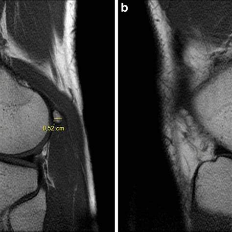 Sagittal T1 Weighted Mri Demonstrated Os Fabella A Sagittal Download Scientific Diagram