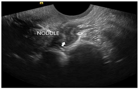 Transvaginal Ultrasound In The Diagnosis And Assessment Of