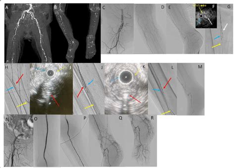 A B Preprocedural Enhanced Computed Tomography C D E Control