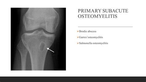 Chronic Osteomyelitis Bone Infection Slides Ppt