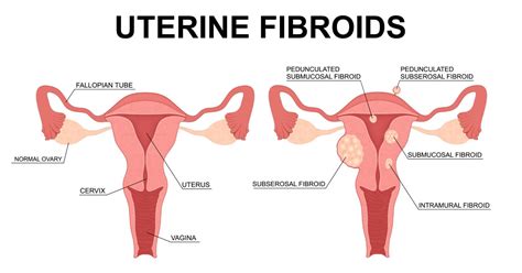 Endometriosis Vs Fibroids American Fibroid Centers