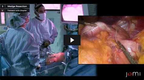 Laparoscopic Resection Of Gastric Gist Tumor Journal Of Medical Insight