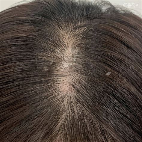 두피각질케어 셀프로 해결한 방법 네이버 블로그
