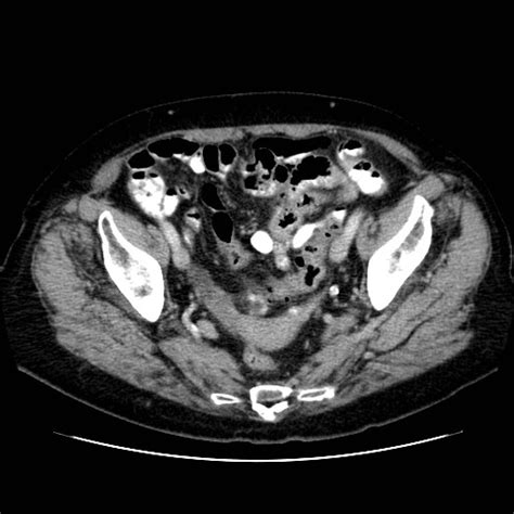 Radiopaedia Case Urinary Bladder Hernia Through Pelvic Floor Id 51116