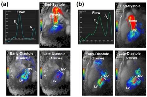 Diastolic Cardiac Function By Mri Encyclopedia Mdpi