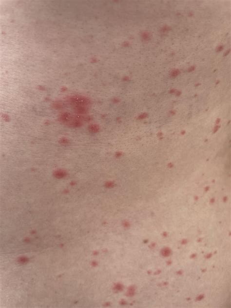 Whole Body Rash After Taking Doxycycline Rdermatologyquestions