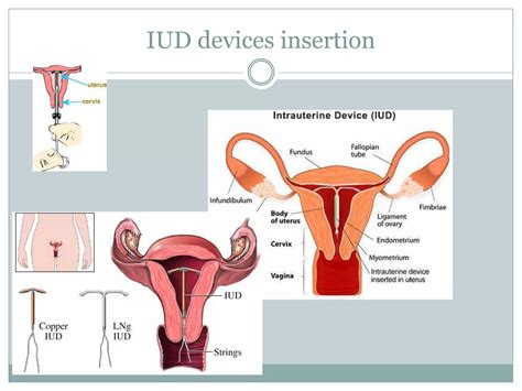 Insertion Of Iud Devices Pptx