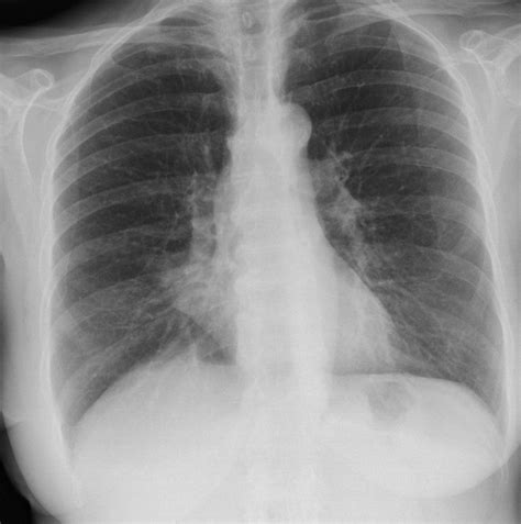 Right Middle Lobe Collapse X Ray