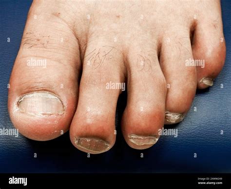 Toenails Of A Hispanic Male Patient With Melanonychia Melanonychia Is