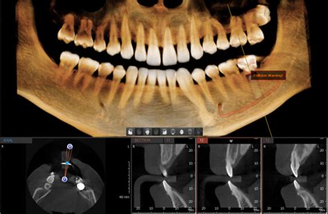Ez3D I Dental Software For 3D Diagnostic Imaging Ewoosoft Open