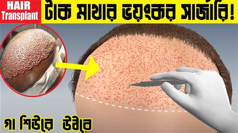টাক মাথায় কিভাবে চুল প্রতিস্থাপন করা হয় । Hair Transplantation