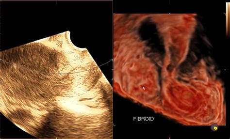 Fibroid Mapping Krishna Ivf Clinic