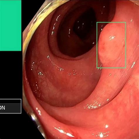 Detection Of A Colorectal Polyp By The Endoaid Computer Aided Detection Download Scientific