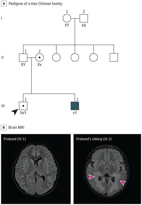 Jama Neurology On Linkedin Male Carrier Of X Linked Adrenal