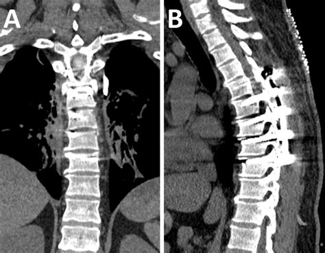 Postoperative Ct Imaging Download Scientific Diagram