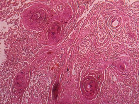 Glioblastoma Histopathologyguru