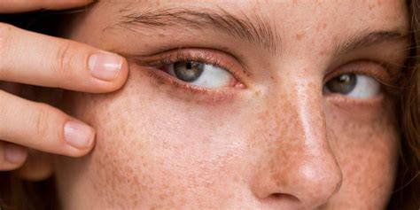 Tipos De Manchas En La Piel Y Como Prevenirlos