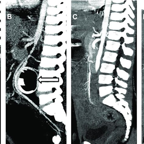 Computed Tomography Angiography Cta Three Dimensional Reconstruction