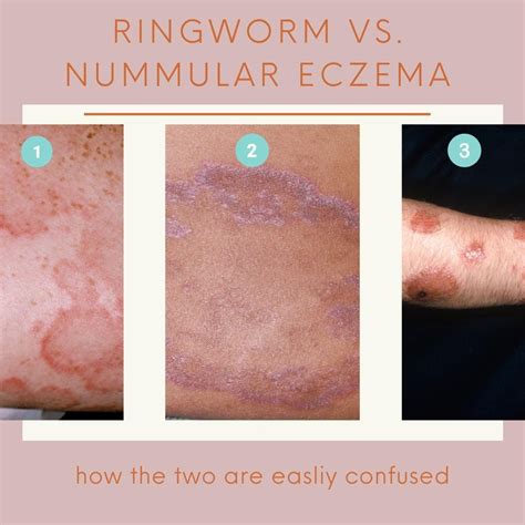 Eczema Nummular Eczema Vs Ringworm Pictures 1080x1080