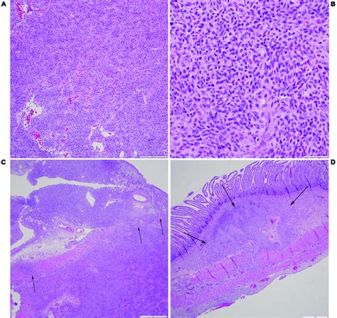 Histological Examination Of Neoplasm A Prominent Vasculature Is