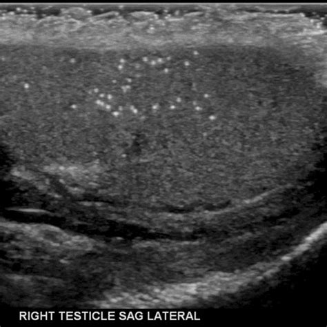 Testicular Microlithiasis Multiple 5 Punctate Download
