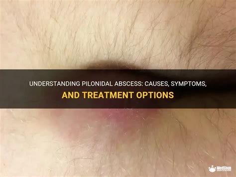 Understanding Pilonidal Abscess Causes Symptoms And Treatment