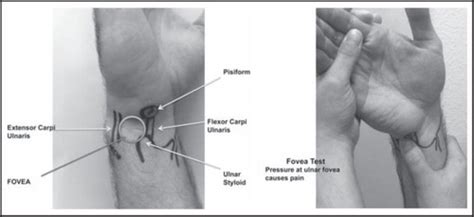 Triangular Fibrocartilage Complex Injuries Early Diagnosis And Proper