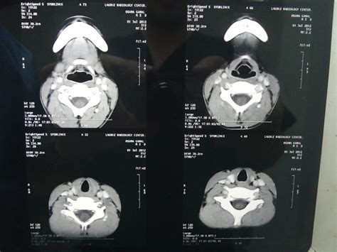 Neuroectodermal Tumor Of The Nose Ct And Mri Of Nasal Cavity