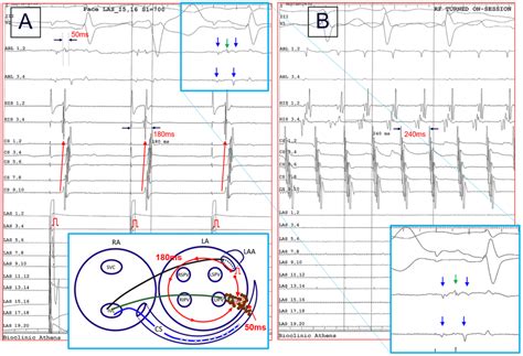 A Pacing From The Left Atrial Appendage Laa Showing The Reversal Of Download Scientific